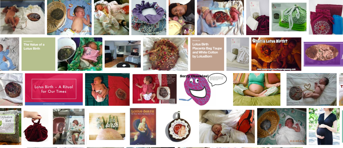 A lotus birth is leaving a newborn attached to a decomposing placenta ...